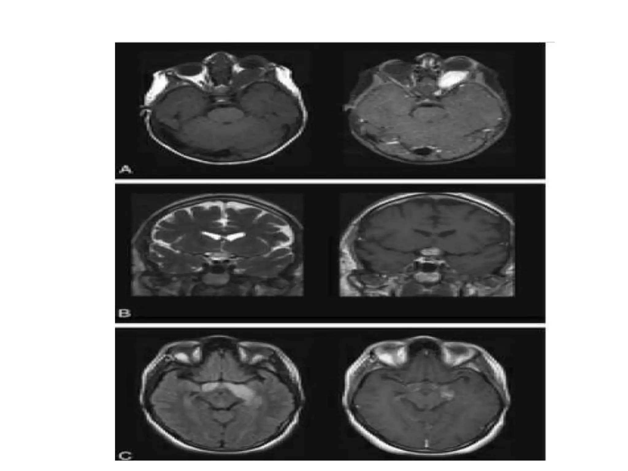 Optic pathway glioma | PPTX