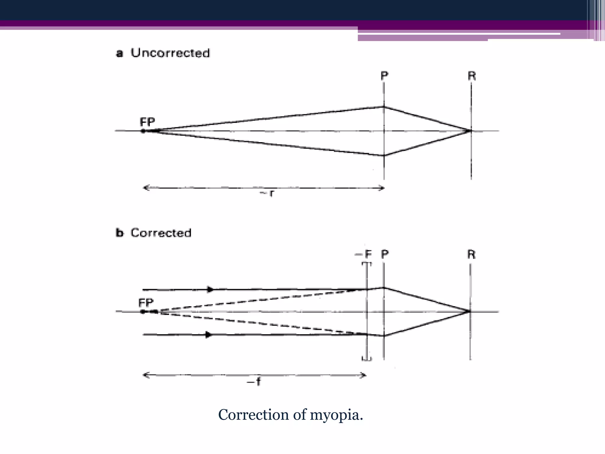 Optics of ametropia | PPTX
