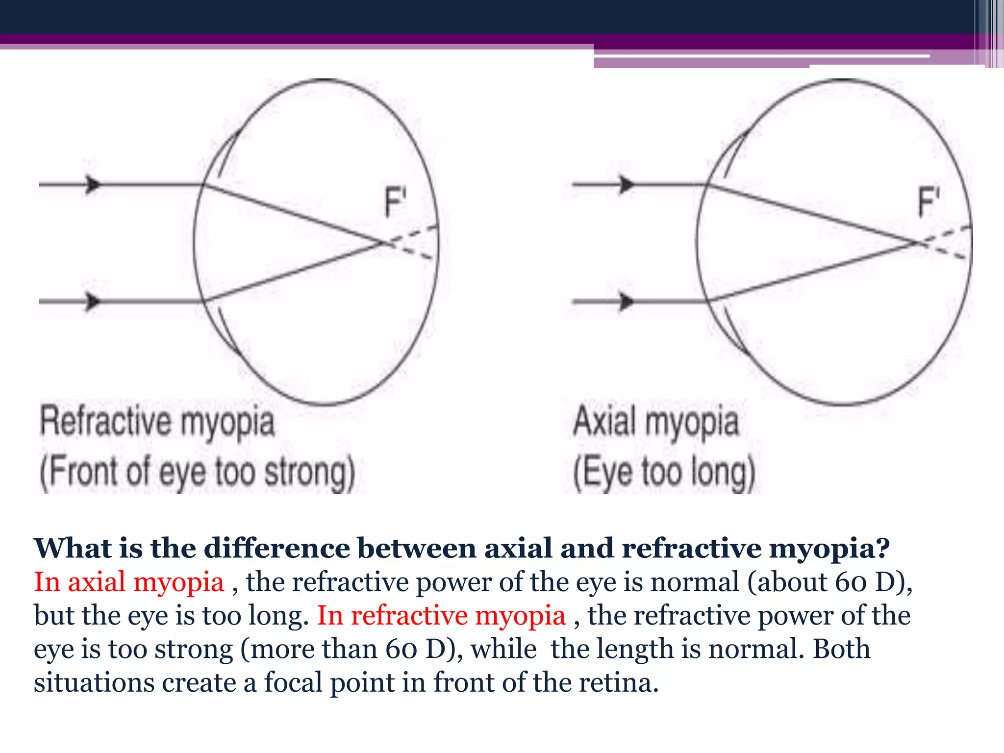 Optics of ametropia | PPTX