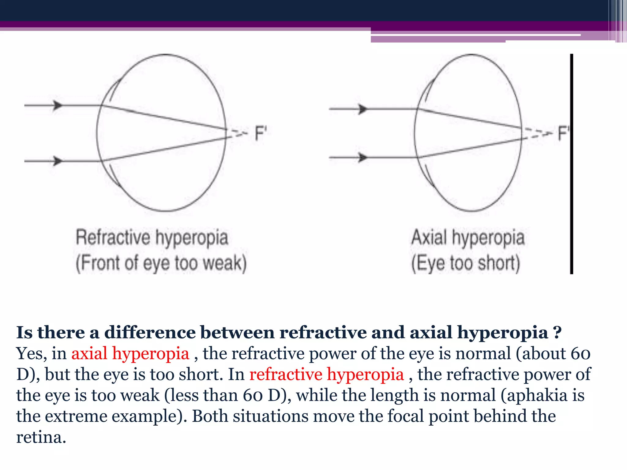 Optics of ametropia | PPTX