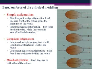 Optics of ametropia | PPTX