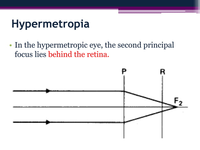Optics of ametropia | PPTX