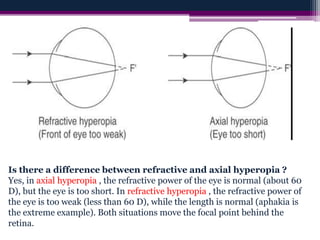 Optics of ametropia | PPTX
