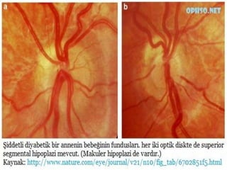 Optik disk konjenital anomalileri | PPTX