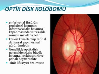 Optik disk konjenital anomalileri | PPTX