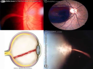 Optik disk konjenital anomalileri | PPTX