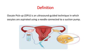 Optimising IVF results with good OPU and ET techniques | PPTX