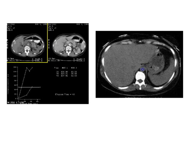 Optimization of ct scan protocol in acute abdomen 2003 revised aa | PPT