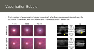 Optimizing image guided laser-induced choroidal neovascularization in ...