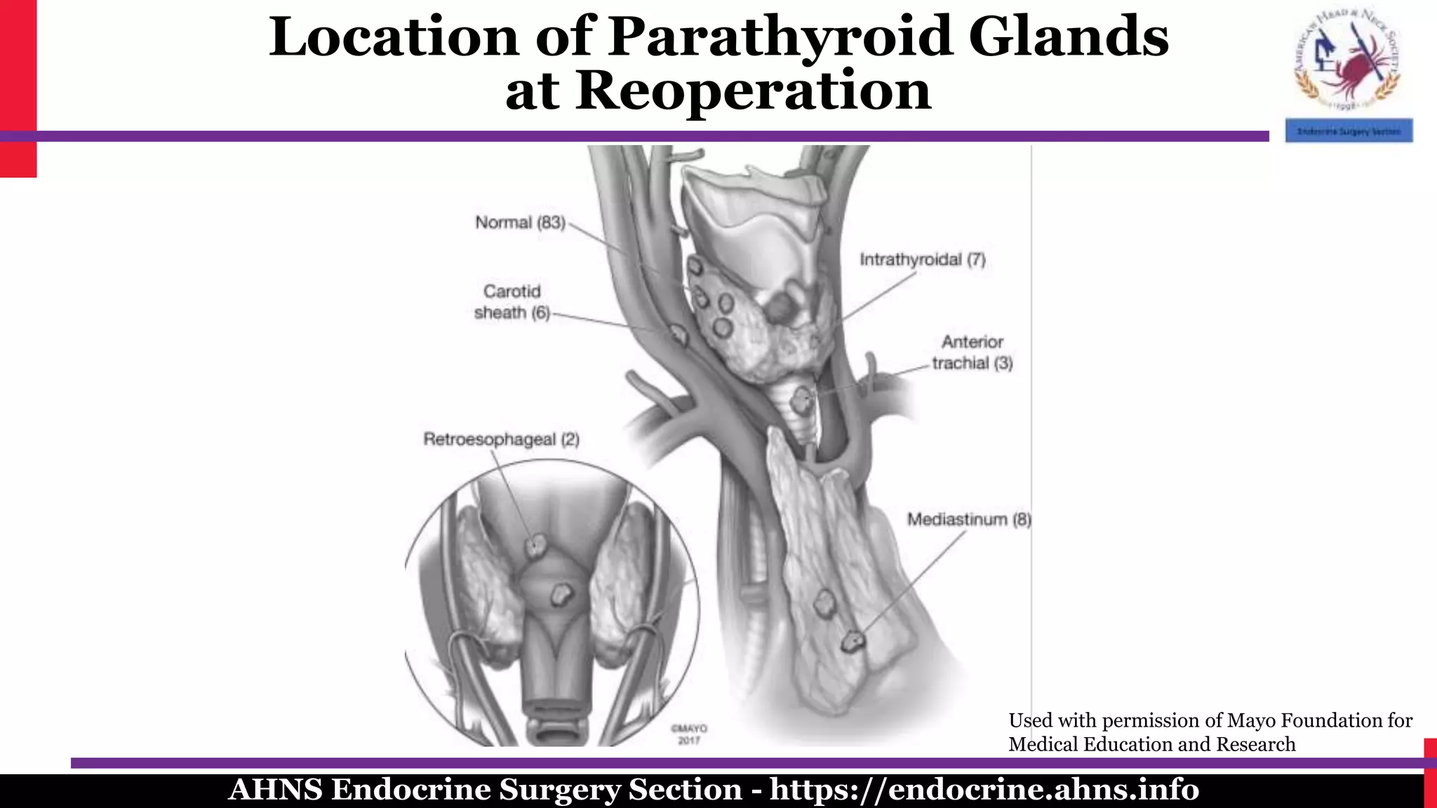 Optimizing outcomes in reoperative parathyroid surgery: AHNS Endocrine ...