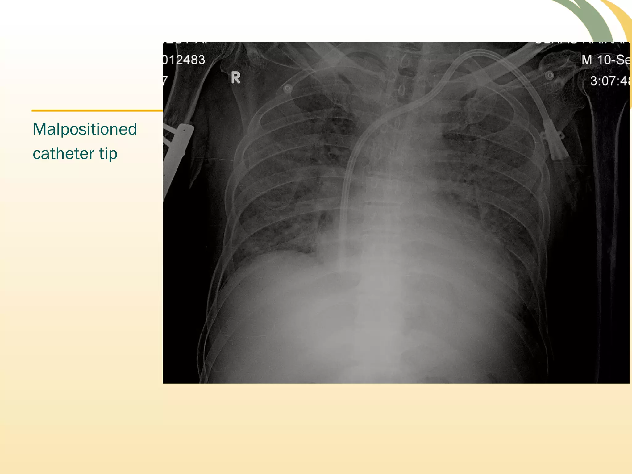 vascular access for dialysis access: seminar | PPT