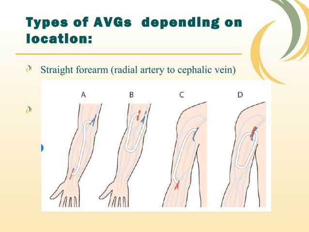 vascular access for dialysis access: seminar | PPT | Blood Disorders ...