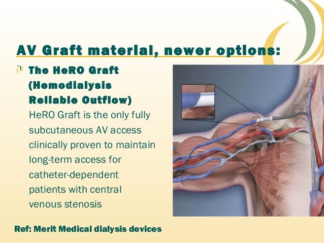 3 Types Of Vascular Access Ports Used In Hemodialysis