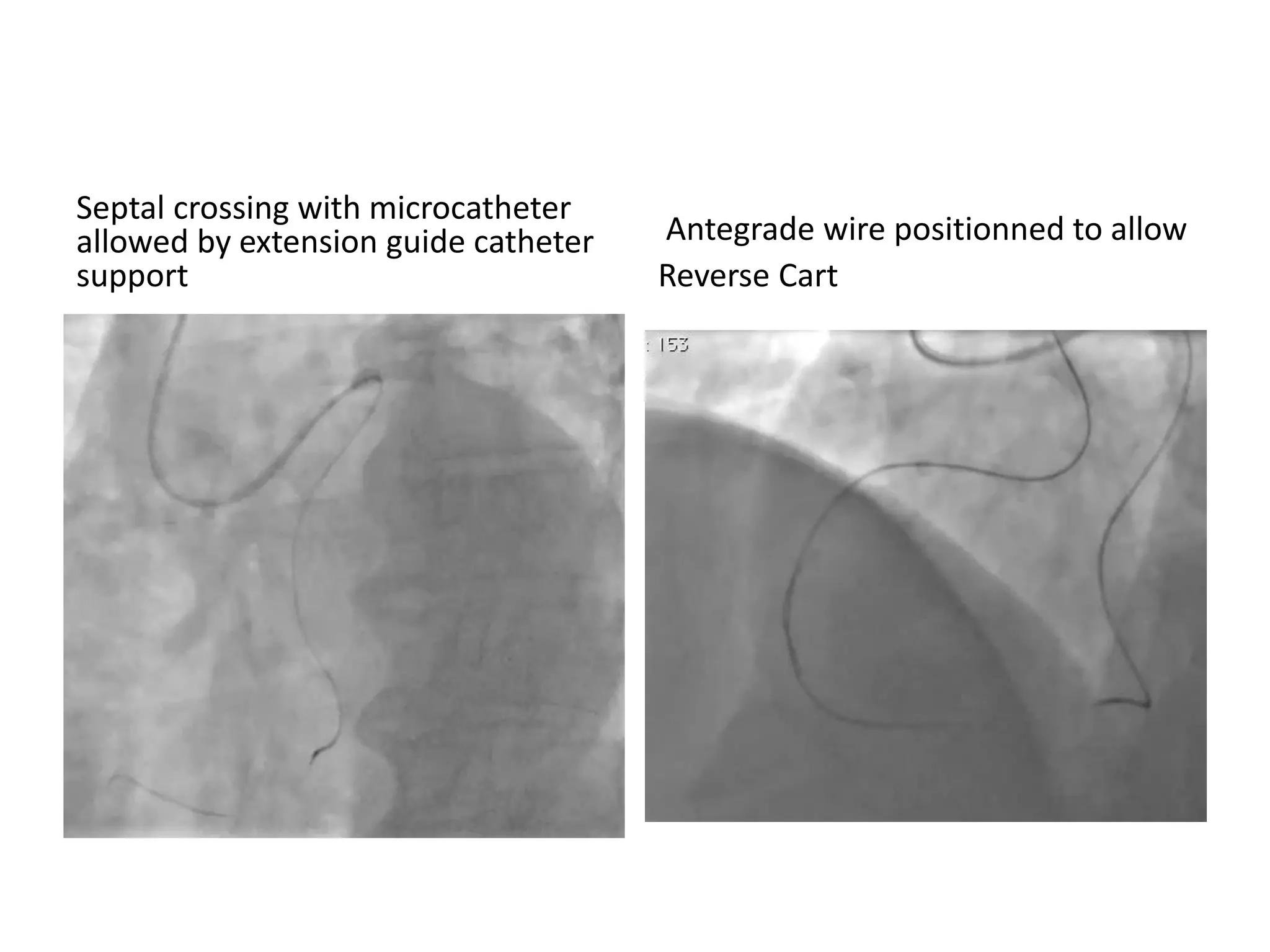 Optimize guide catheter support | PDF