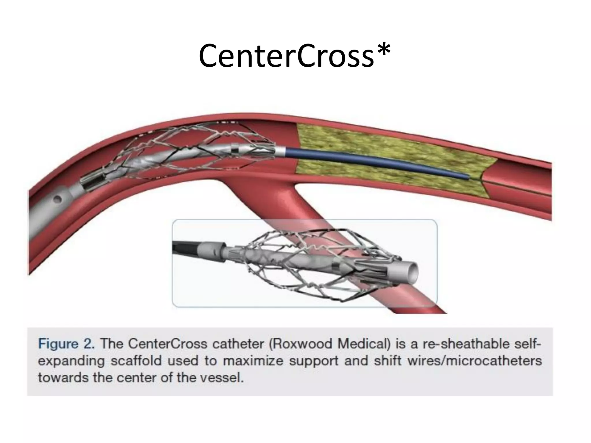 Optimize guide catheter support | PDF