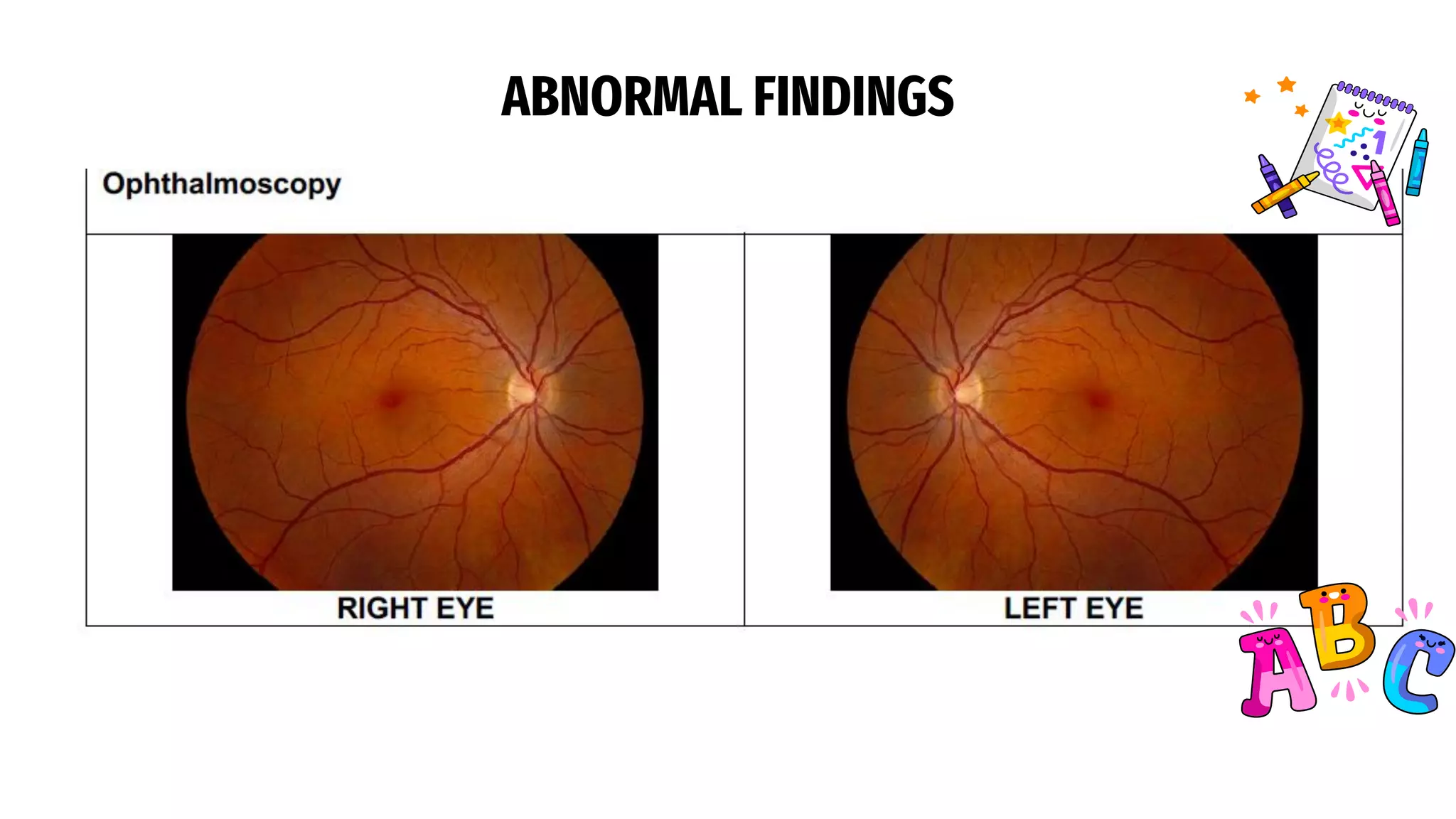 OPTOMETRY CASE ANALYSIS (PEDIATRIC PATIENT) | PDF