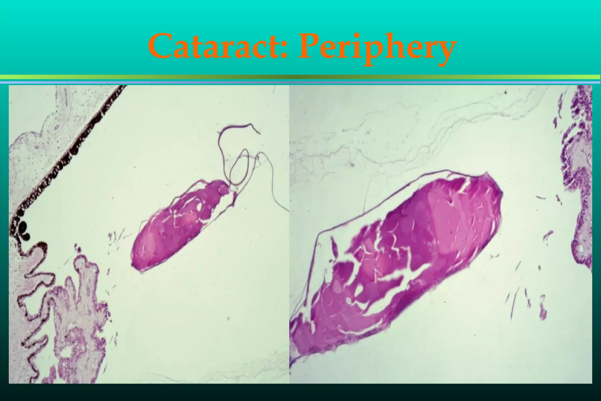 Cornea and Lens Histopathology Refractive Surgery Cataracts High Myopia ...