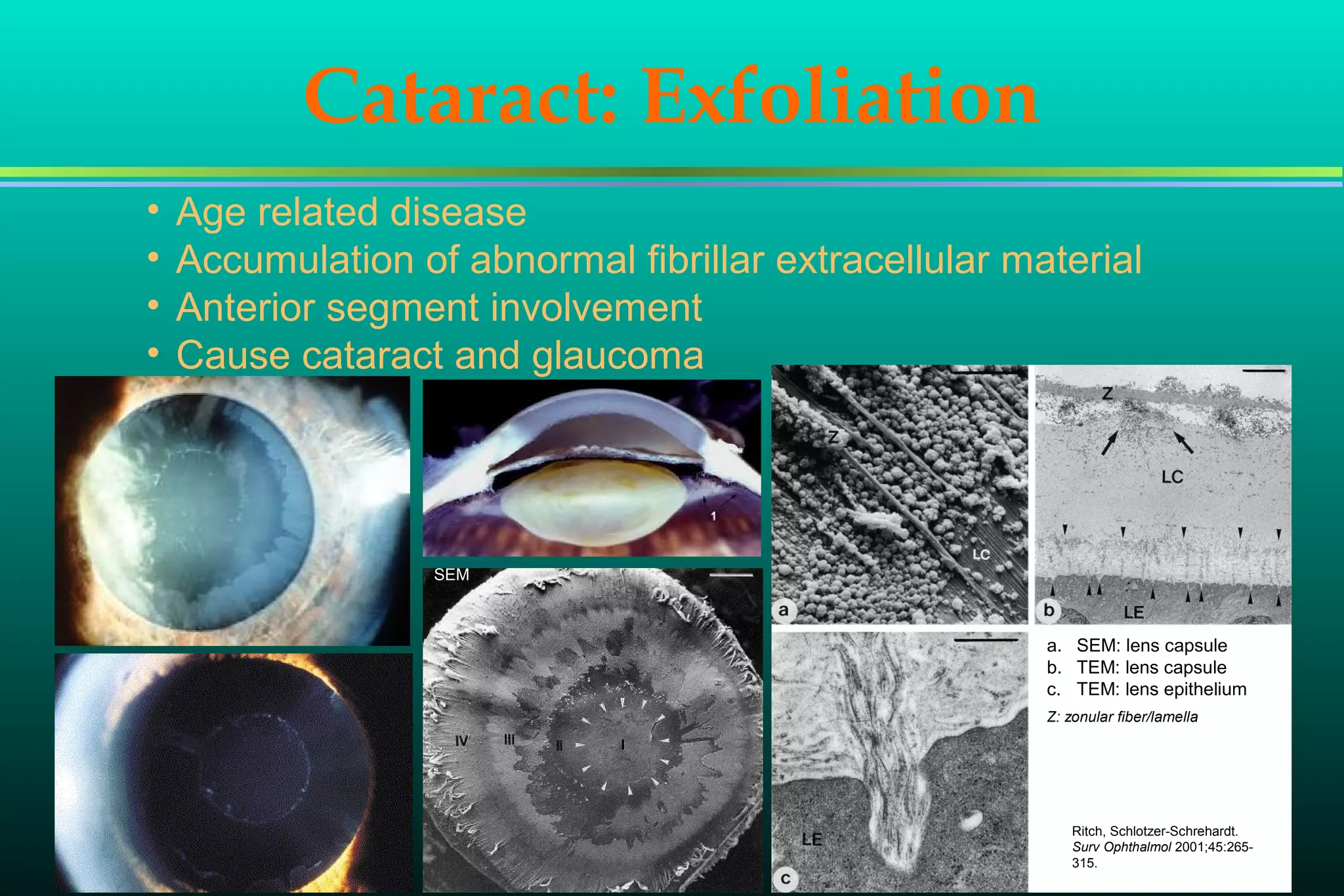 Cornea and Lens Histopathology Refractive Surgery Cataracts High Myopia ...