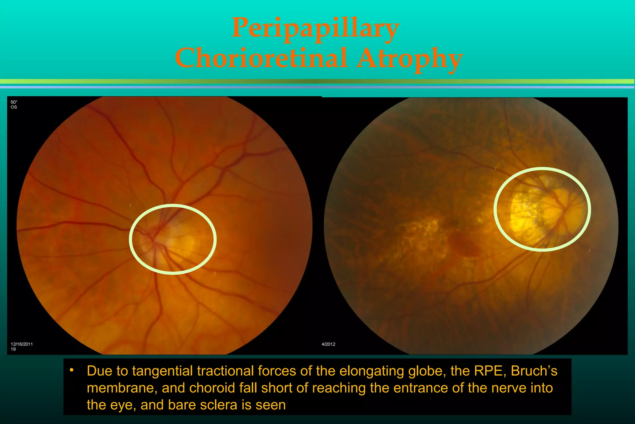 Cornea and Lens Histopathology Refractive Surgery Cataracts High Myopia ...