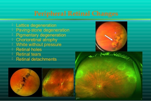 Cornea and Lens Histopathology Refractive Surgery Cataracts High Myop…