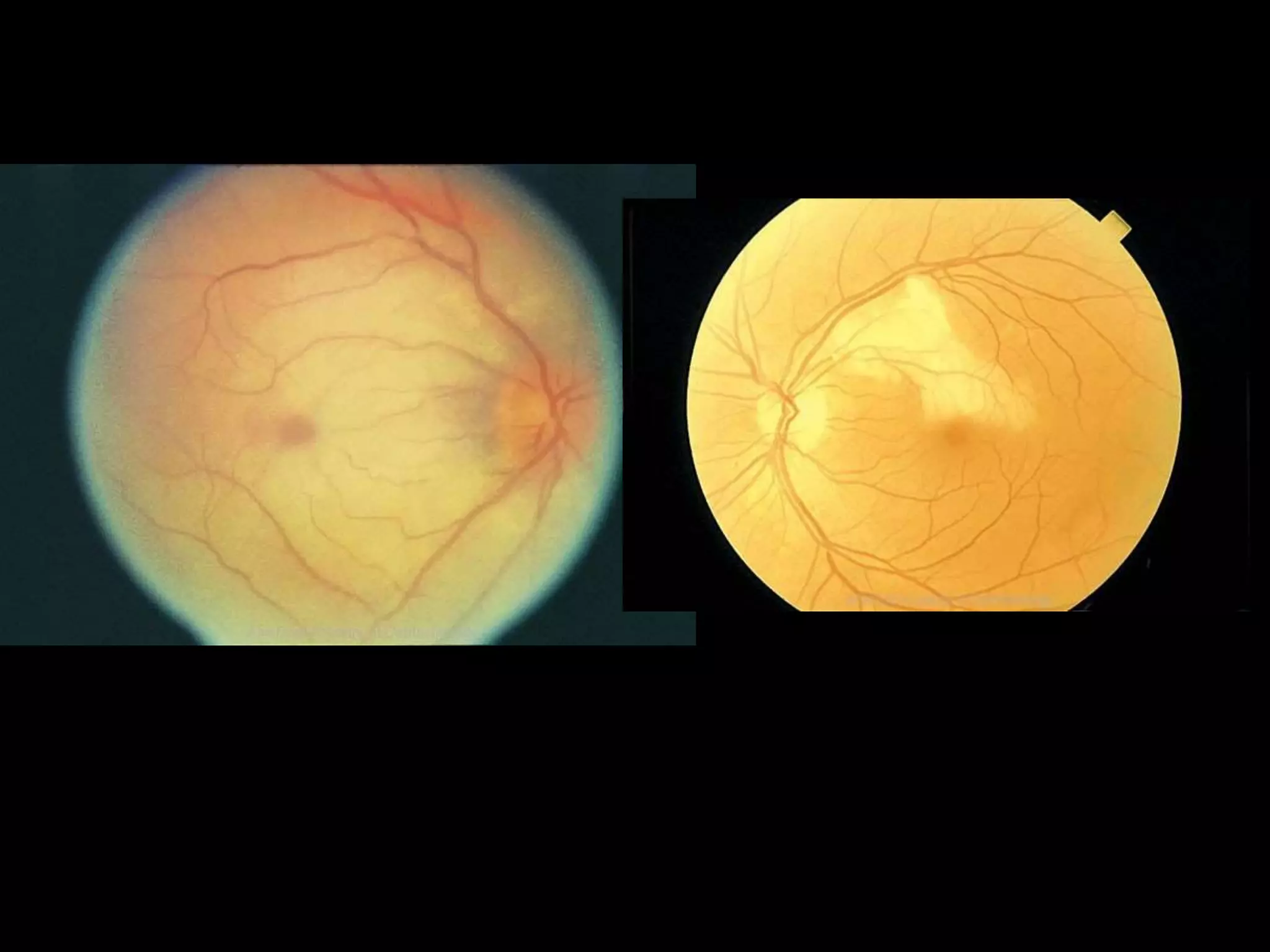 Transient visual loss localization and visual field interpretation | PPT