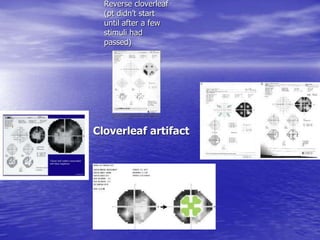 Transient visual loss localization and visual field interpretation | PPT