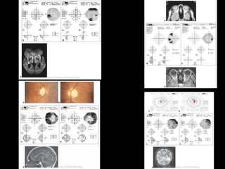 Transient visual loss localization and visual field interpretation | PPT