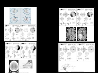 Transient visual loss localization and visual field interpretation | PPT