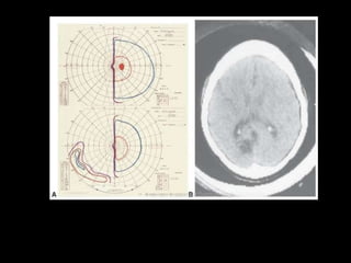 Transient visual loss localization and visual field interpretation | PPT