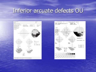 Transient visual loss localization and visual field interpretation | PPT