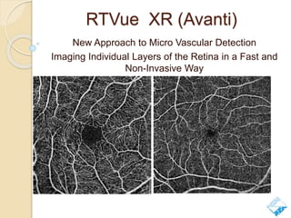Optovue OCT-A quick review | PPTX