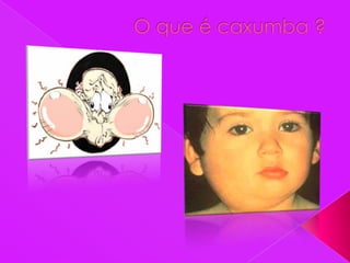 O que é caxumba | PPTX