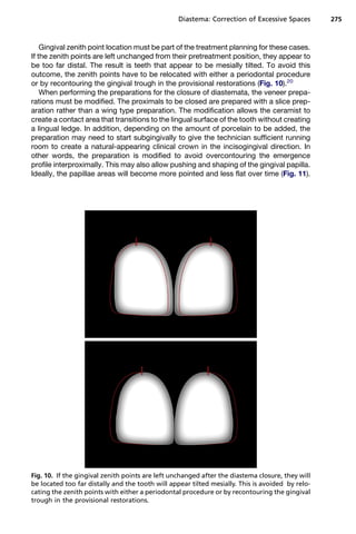 Diastema Correction of Excessive Spaces | PDF