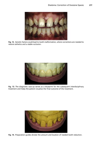 Diastema Correction of Excessive Spaces | PDF