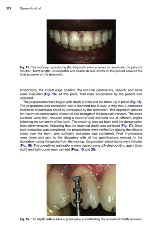 Diastema Correction of Excessive Spaces | PDF