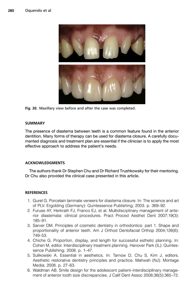 Diastema Correction of Excessive Spaces | PDF | Dental Health ...