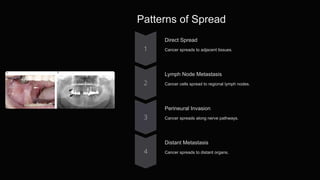 the impact Oral-Cavity-Cancer-An-Overview.pptx