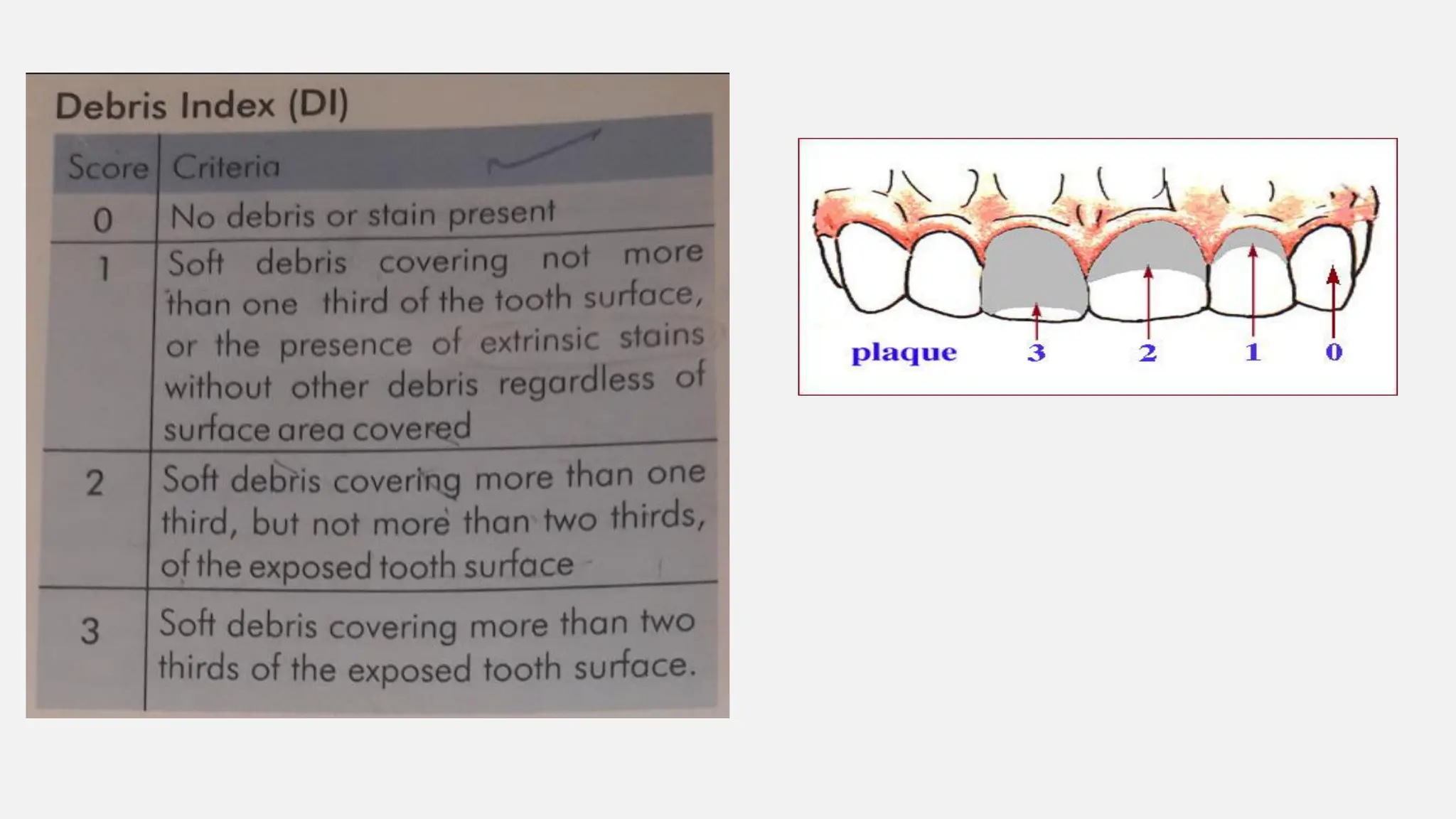 Oral Hygine Index and oral hygiene index simplified | PDF