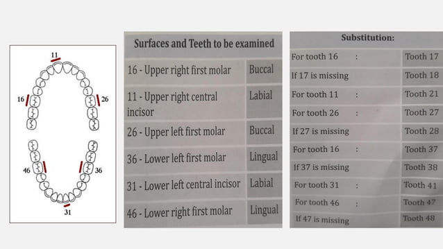 Oral Hygine Index and oral hygiene index simplified | PDF