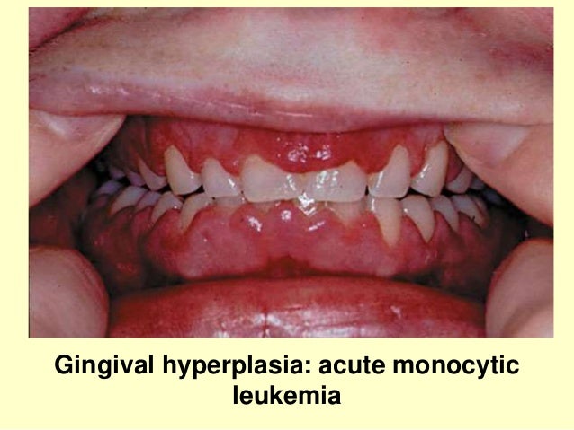Oral manifestations of systemic diseases