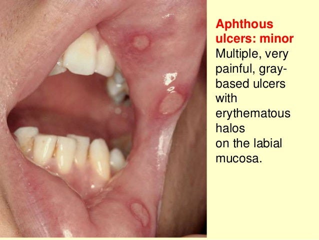 Oral manifestations of systemic diseases