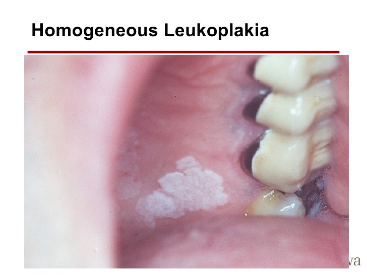 Oral Pathology