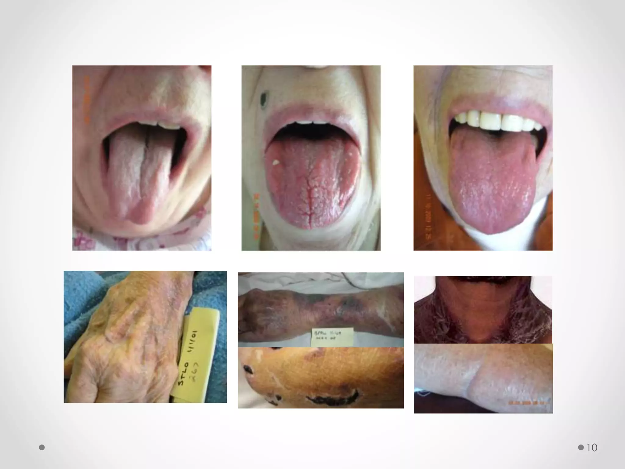 Oral and Cutaneous Signs of Vitamin, Zinc and Fatty Acid Deficiency | PPT