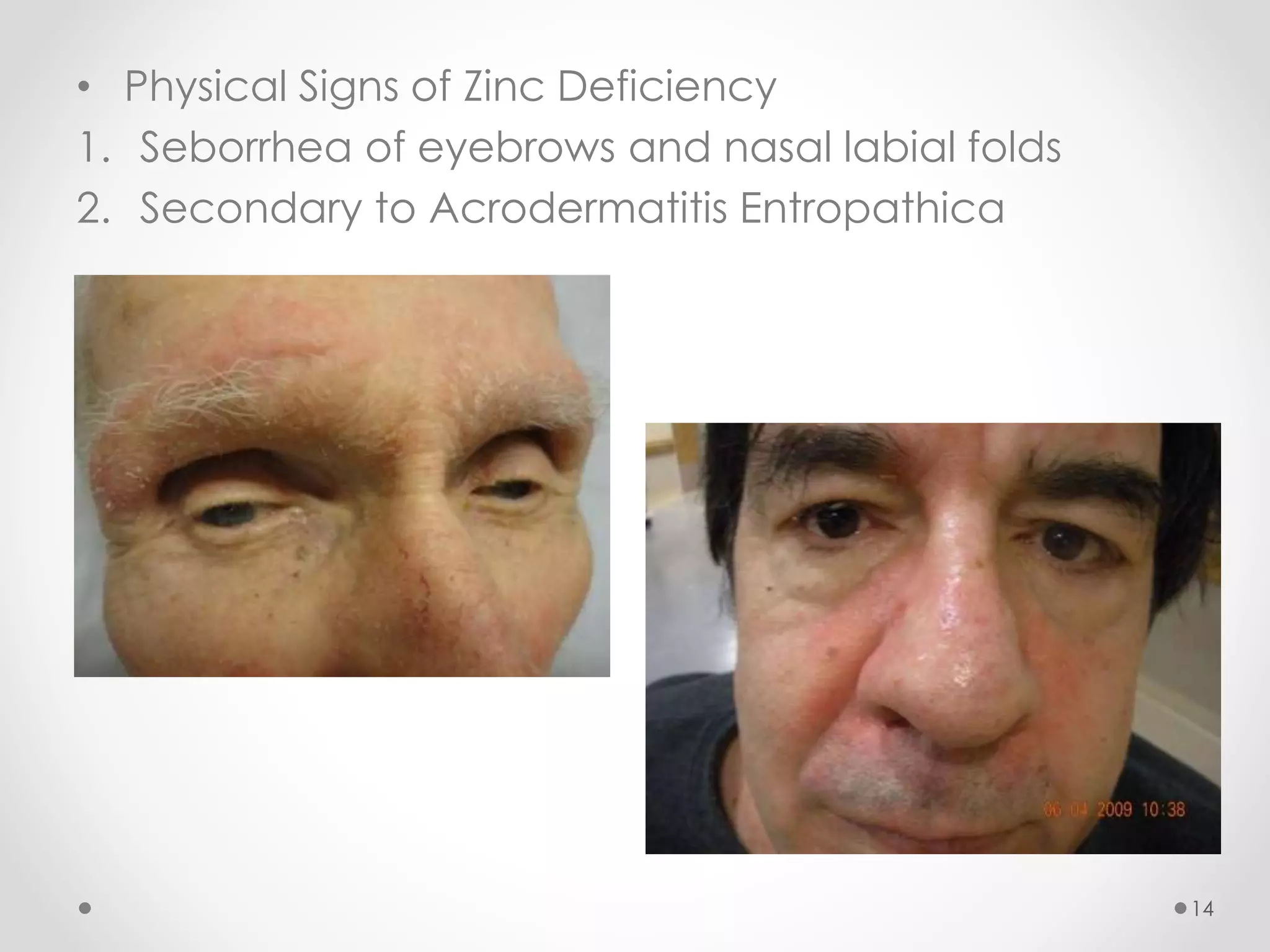 Oral and Cutaneous Signs of Vitamin, Zinc and Fatty Acid Deficiency | PPT
