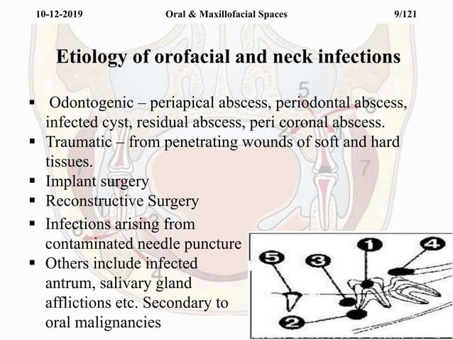 Oral and Maxillofacial Infection | PPTX | Dental Health | Diseases and ...