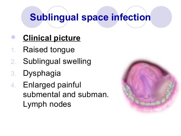Oral and maxillofacial spaces of infection
