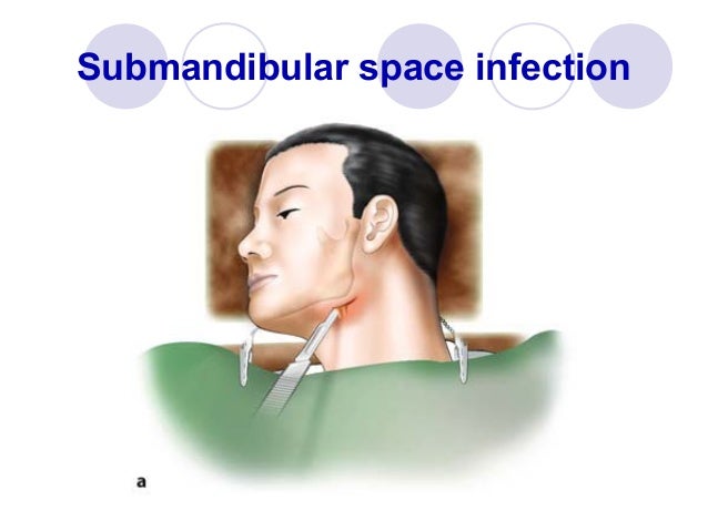 Oral and maxillofacial spaces of infection