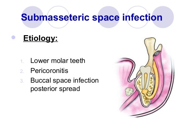 Oral and maxillofacial spaces of infection