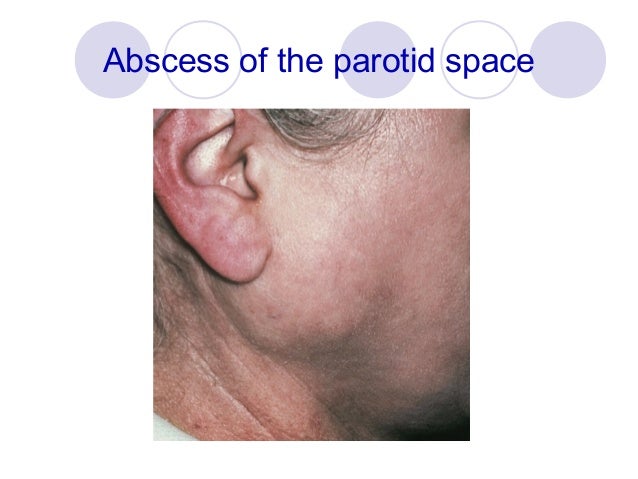 Oral and maxillofacial spaces of infection