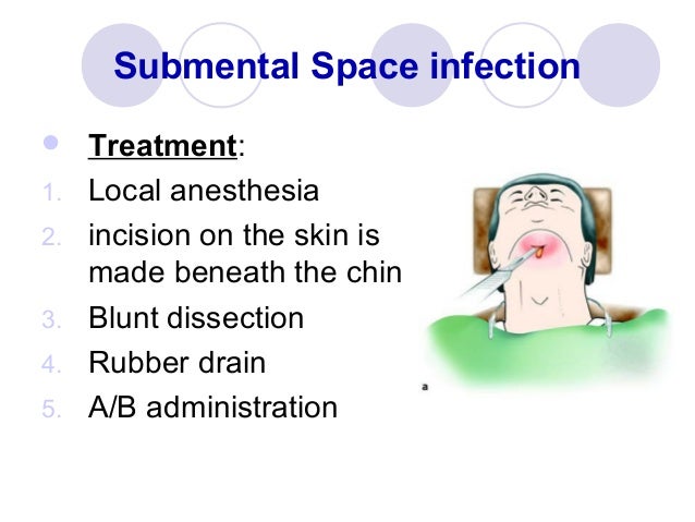 Oral and maxillofacial spaces of infection